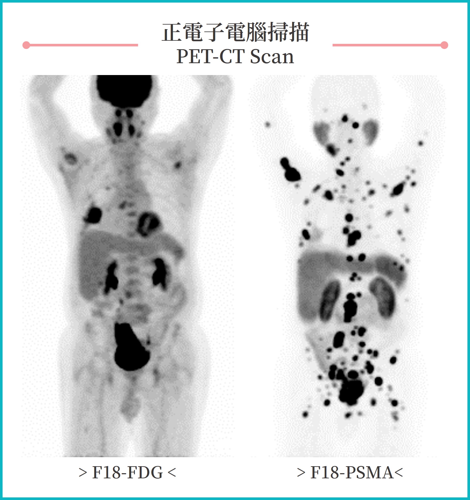 Scanning examinations for diagnosing prostate cancer | 聖德肋撒醫院-掃描部 | St ...