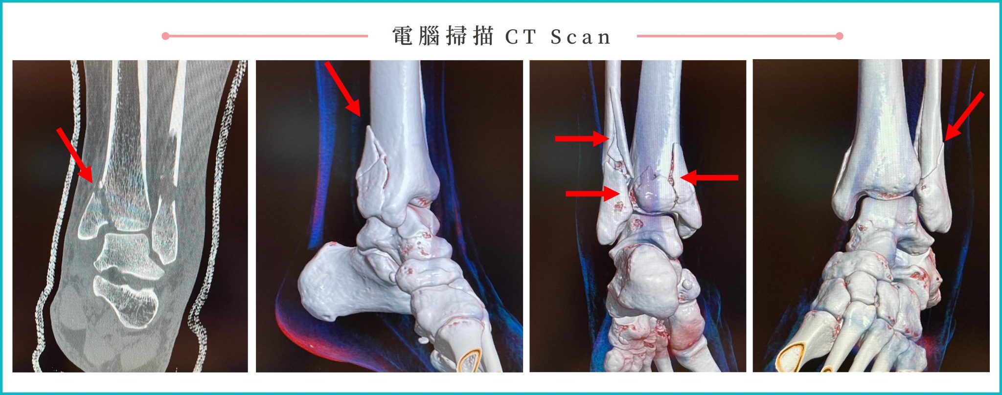 Computed Tomography (CT): Bone Fractures | 聖德肋撒醫院-掃描部 | St. Teresa’s ...